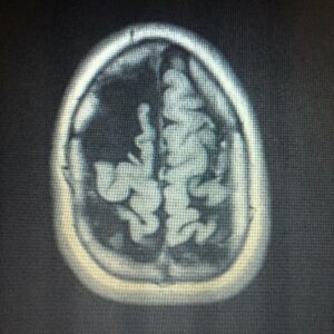 What Is Shaken Baby Syndrome? | The Shaken Baby Alliance